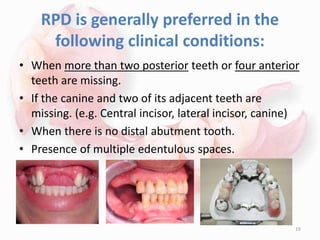 01- INTRODUCTION AND CLASSIFICATION PARTIAL DENTURE.pptx