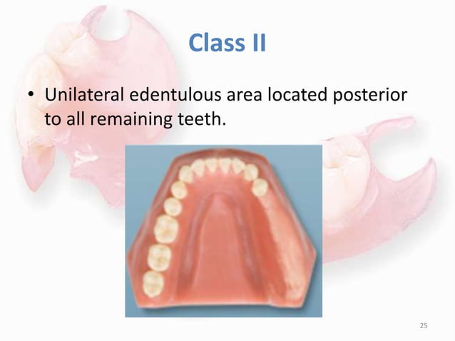 01- INTRODUCTION AND CLASSIFICATION PARTIAL DENTURE.pptx | Dental ...