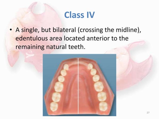 01- INTRODUCTION AND CLASSIFICATION PARTIAL DENTURE.pptx | Dental ...