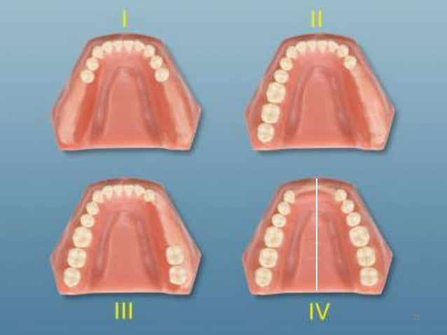 01- INTRODUCTION AND CLASSIFICATION PARTIAL DENTURE.pptx | Dental ...