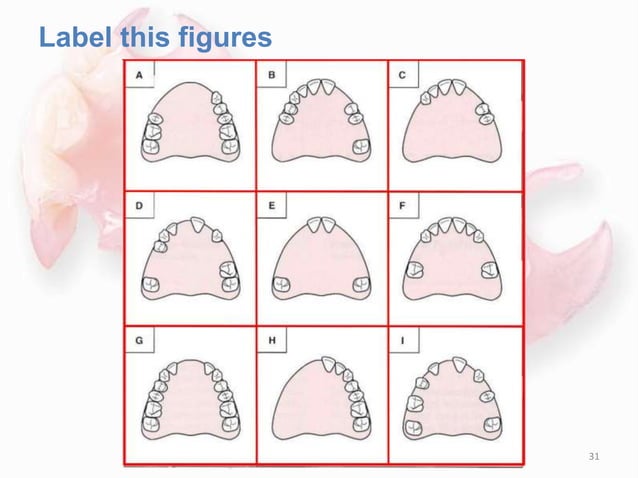 01- INTRODUCTION AND CLASSIFICATION PARTIAL DENTURE.pptx | Dental ...