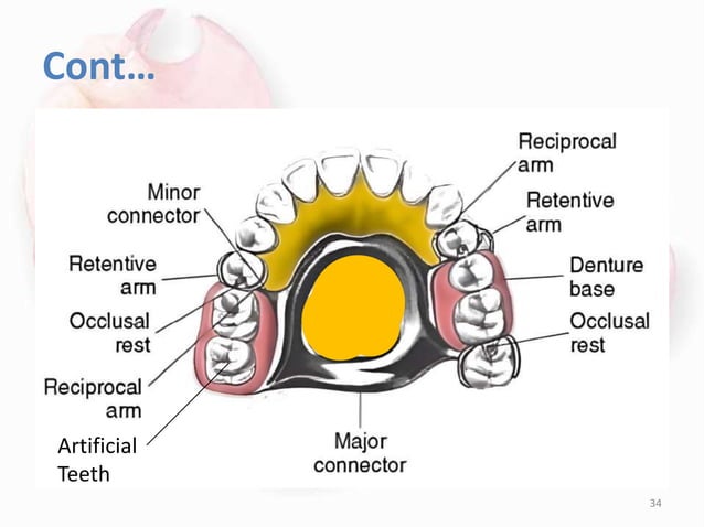 01- INTRODUCTION AND CLASSIFICATION PARTIAL DENTURE.pptx | Dental ...