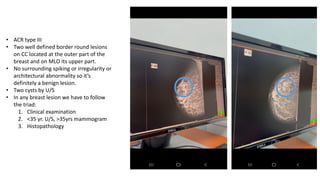 01-Mammogrammy by dr.Abdullah.pdf