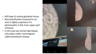 01-Mammogrammy by dr.Abdullah.pdf