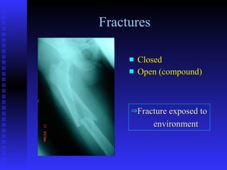 ortho 01 management of open fracture-update by kk 31052010 | PPT