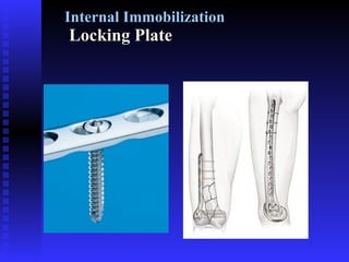ortho 01 management of open fracture-update by kk 31052010 | PPT