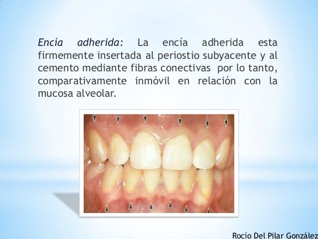 Encia Adherida Encia Libre