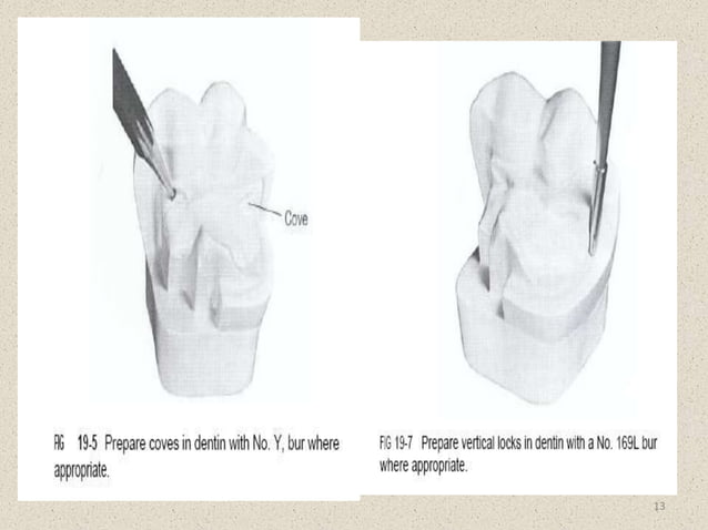 010.complex amalgam restoration | PPTX | Oral care | Personal Care