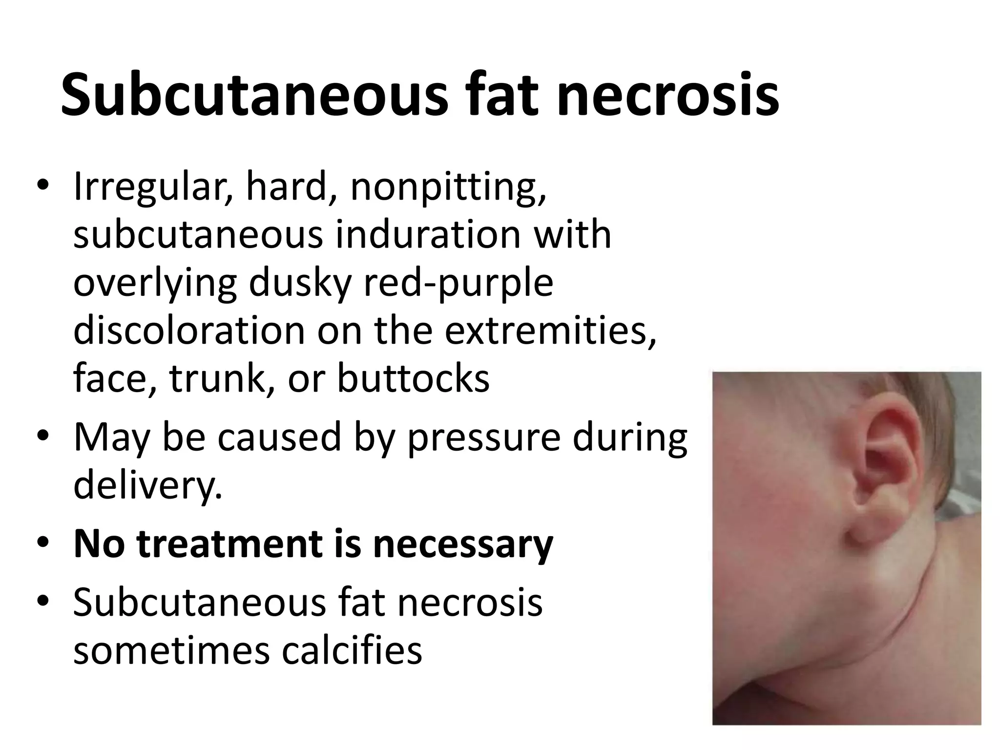 Seminar birth injuries in newborn | PPTX