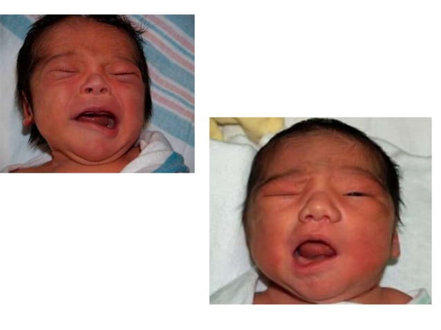 Seminar birth injuries in newborn | PPT