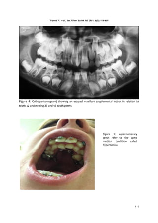 Supernumerary teeth(hyperdontia) | PDF