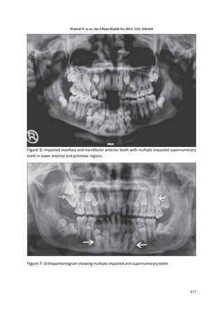 Supernumerary teeth(hyperdontia) | PDF