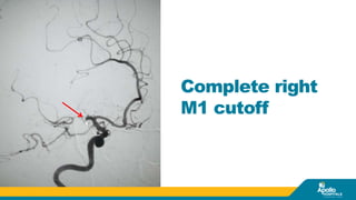 Intervention in acute ischemic stroke | PPTX