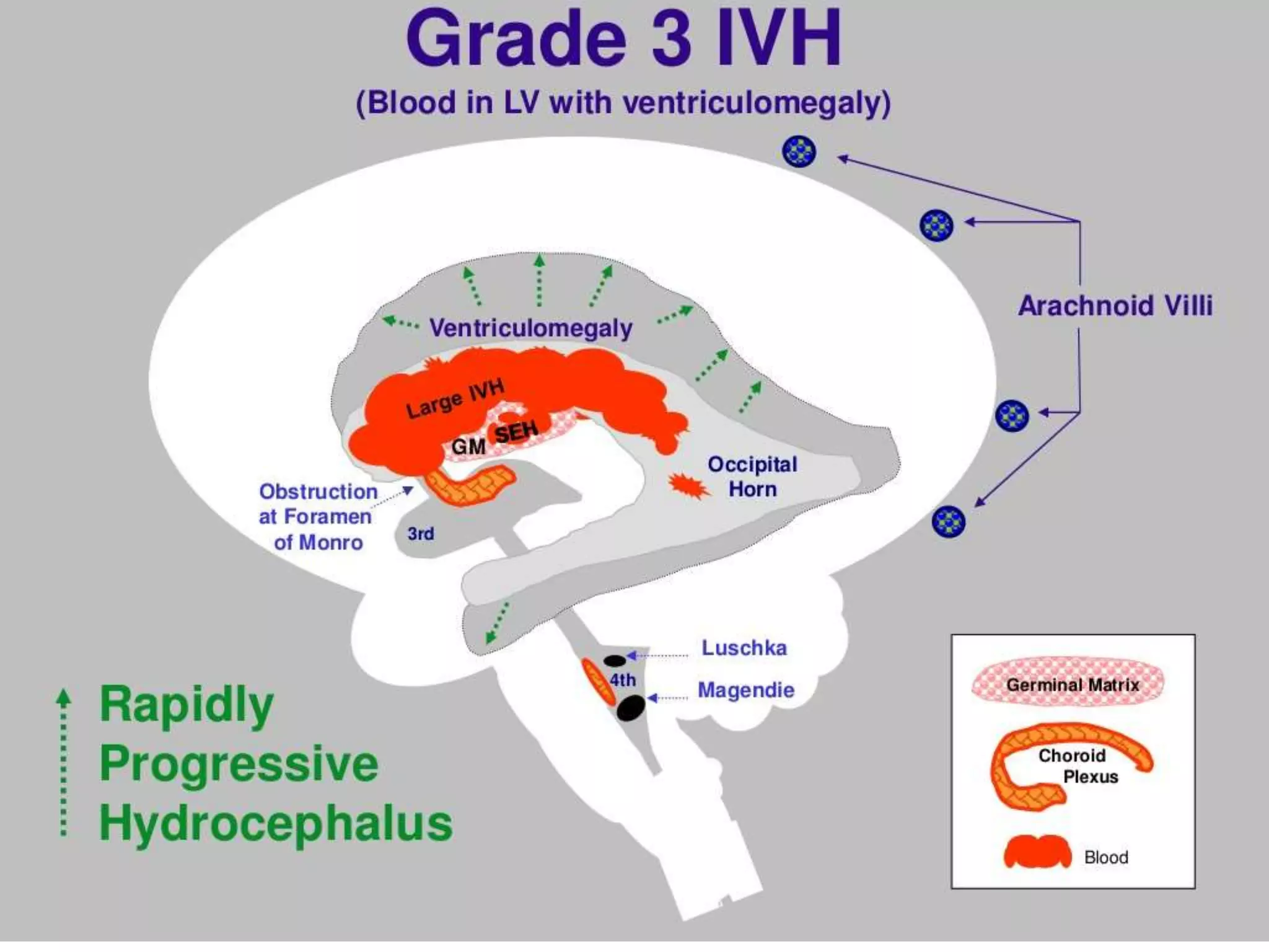 seminar intraventricular hemorrage and birth defects | PPT