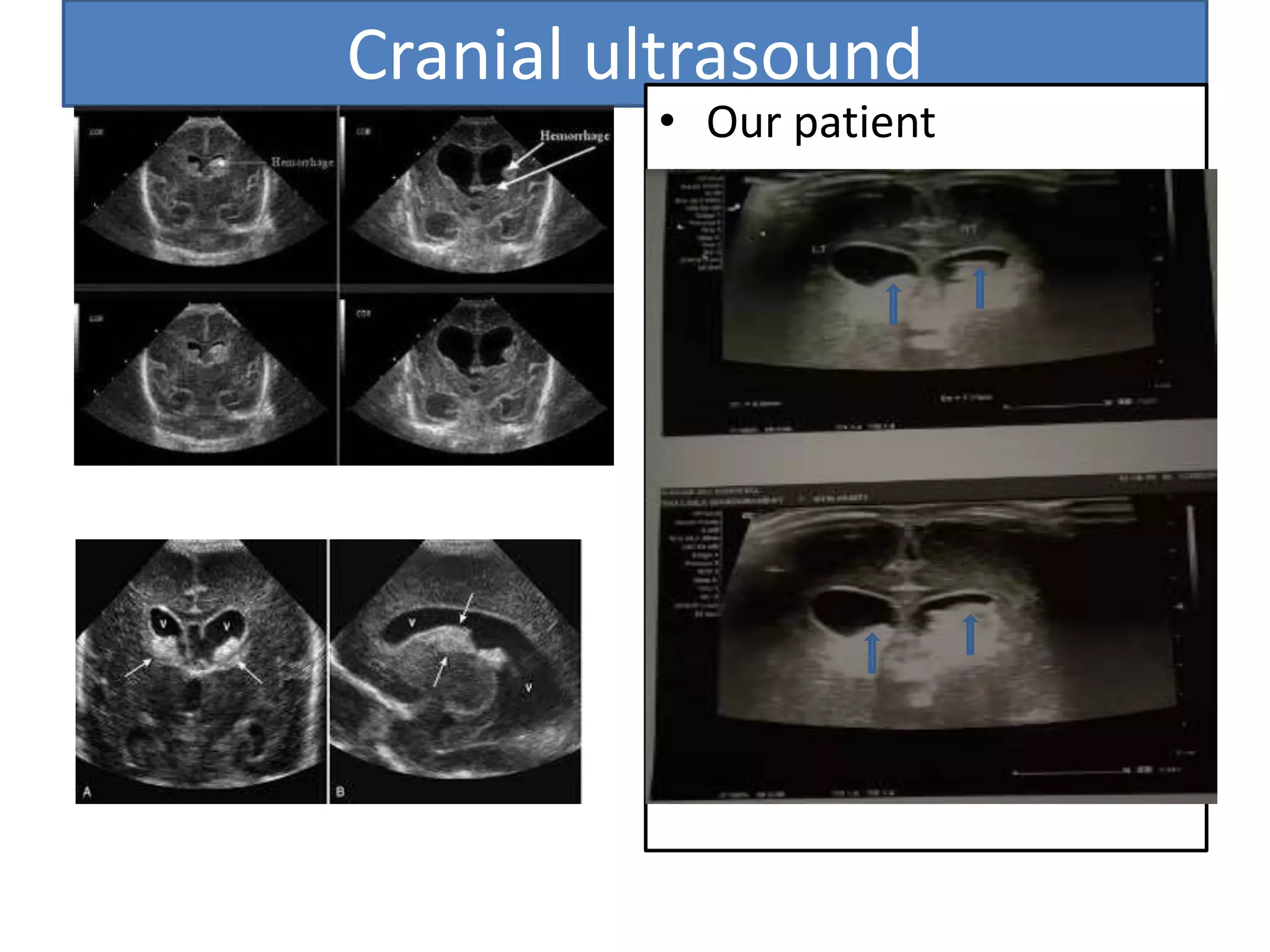 seminar intraventricular hemorrage and birth defects | PPT