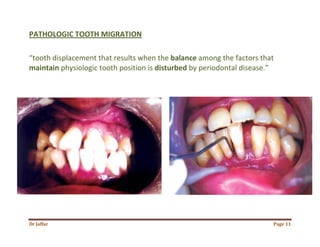 012.Trauma from Occlusion | PDF