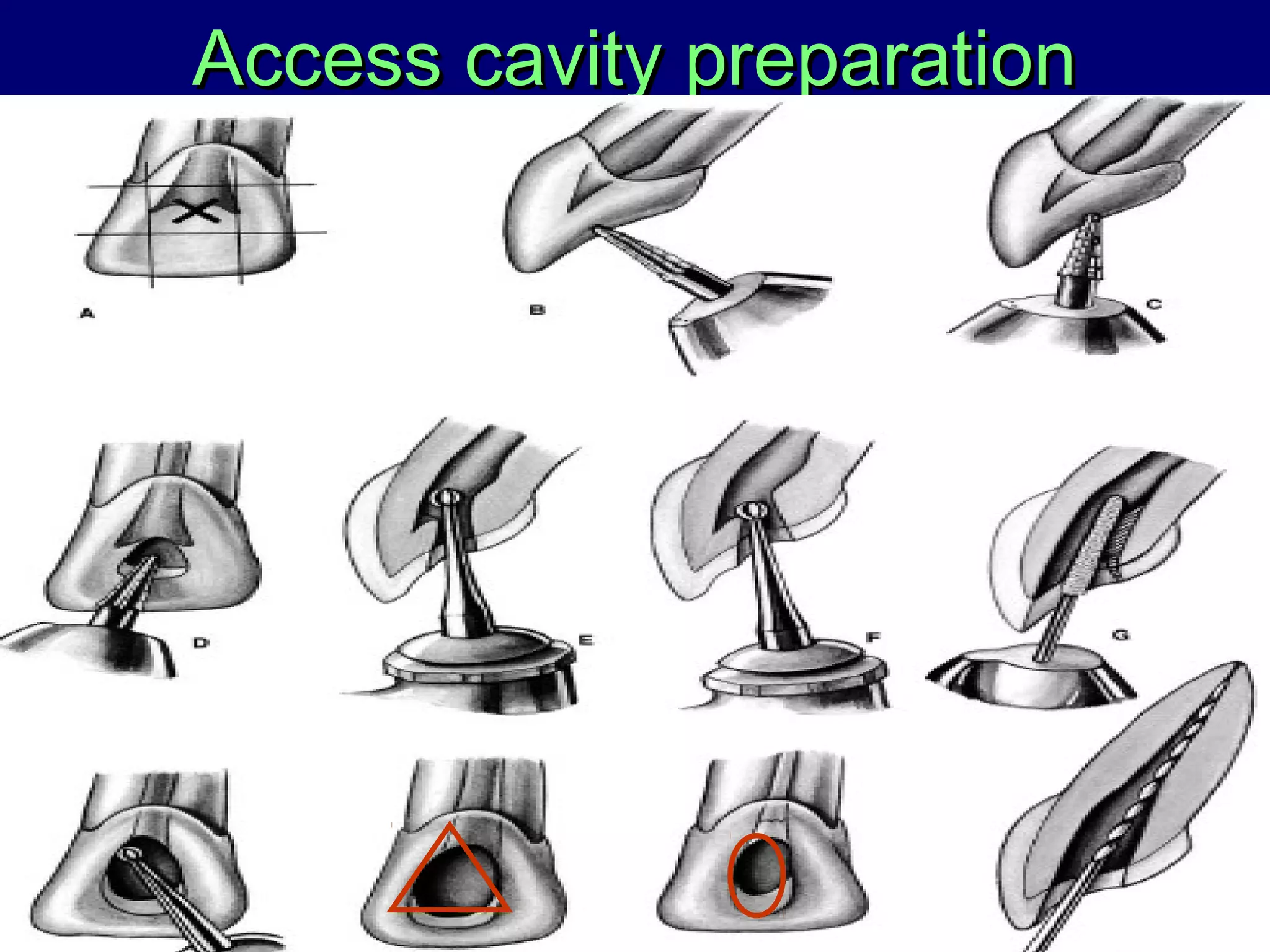 012. access cavity preparation | PPT