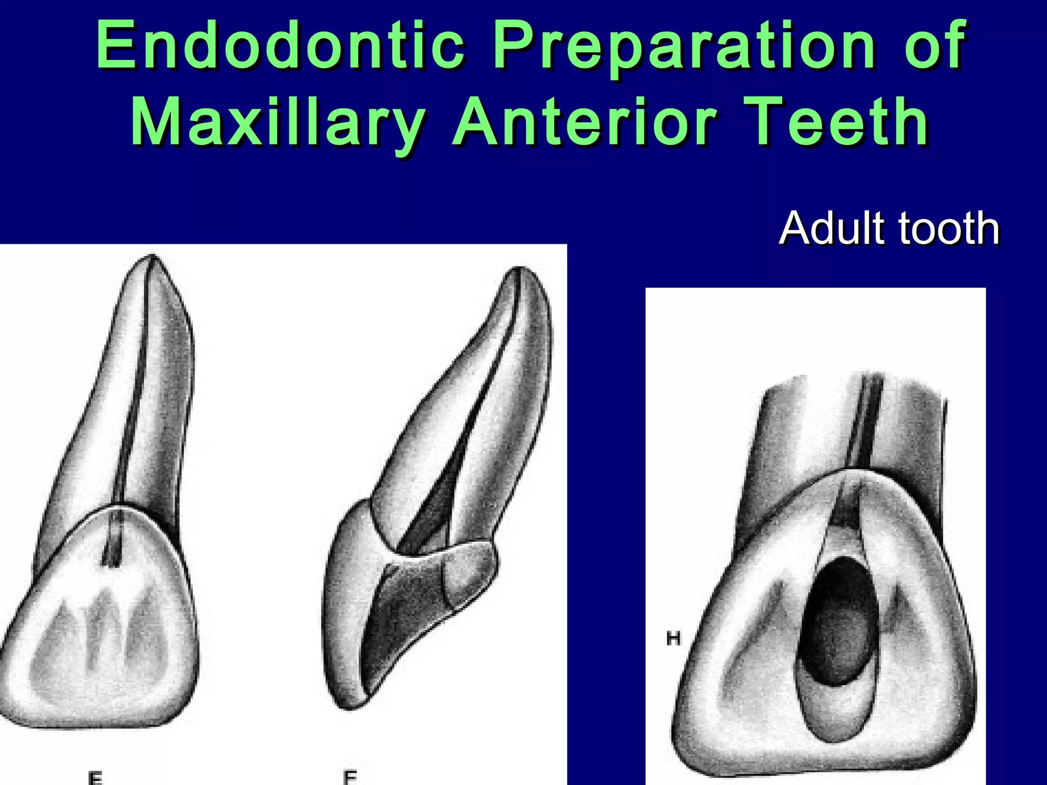 012. access cavity preparation | PPT
