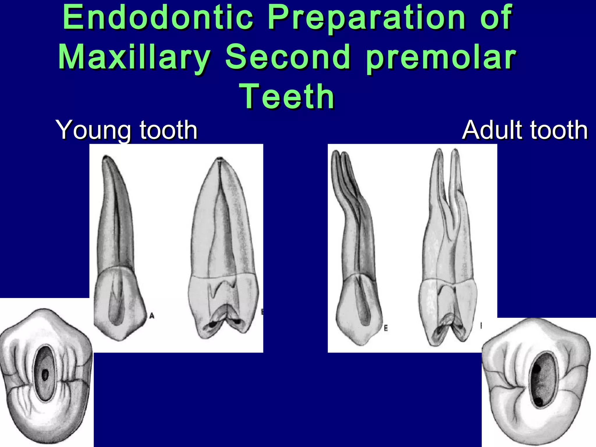 012. access cavity preparation | PPT