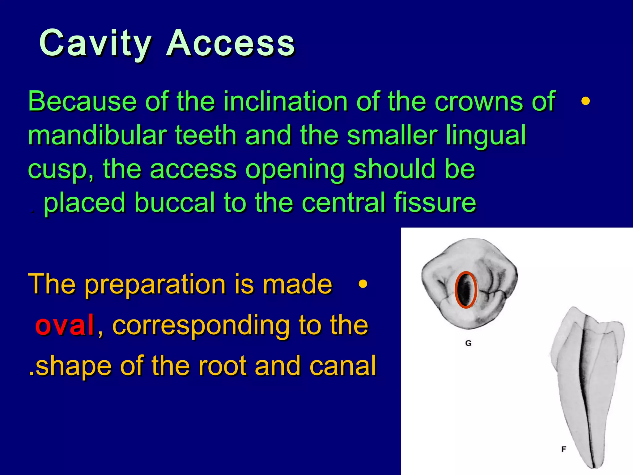 012. access cavity preparation | PPT