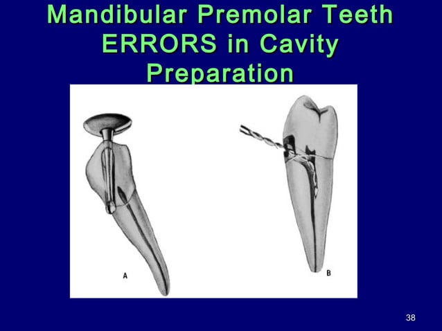 012. access cavity preparation | PPT | Dental Health | Diseases and ...