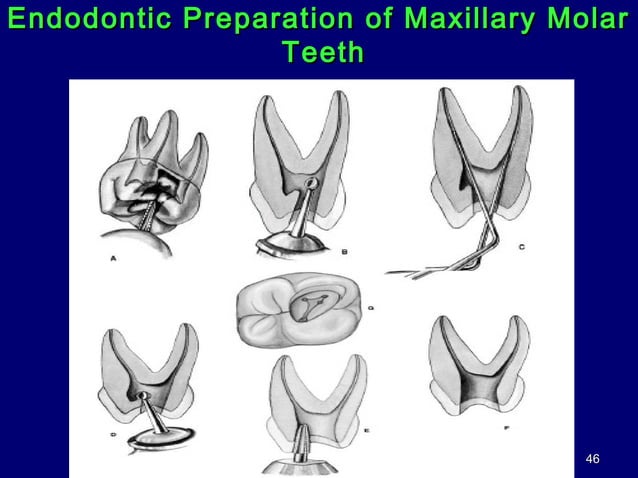 012. access cavity preparation | PPT | Dental Health | Diseases and ...