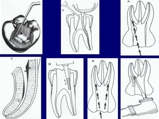 012. access cavity preparation | PPT | Dental Health | Diseases and ...