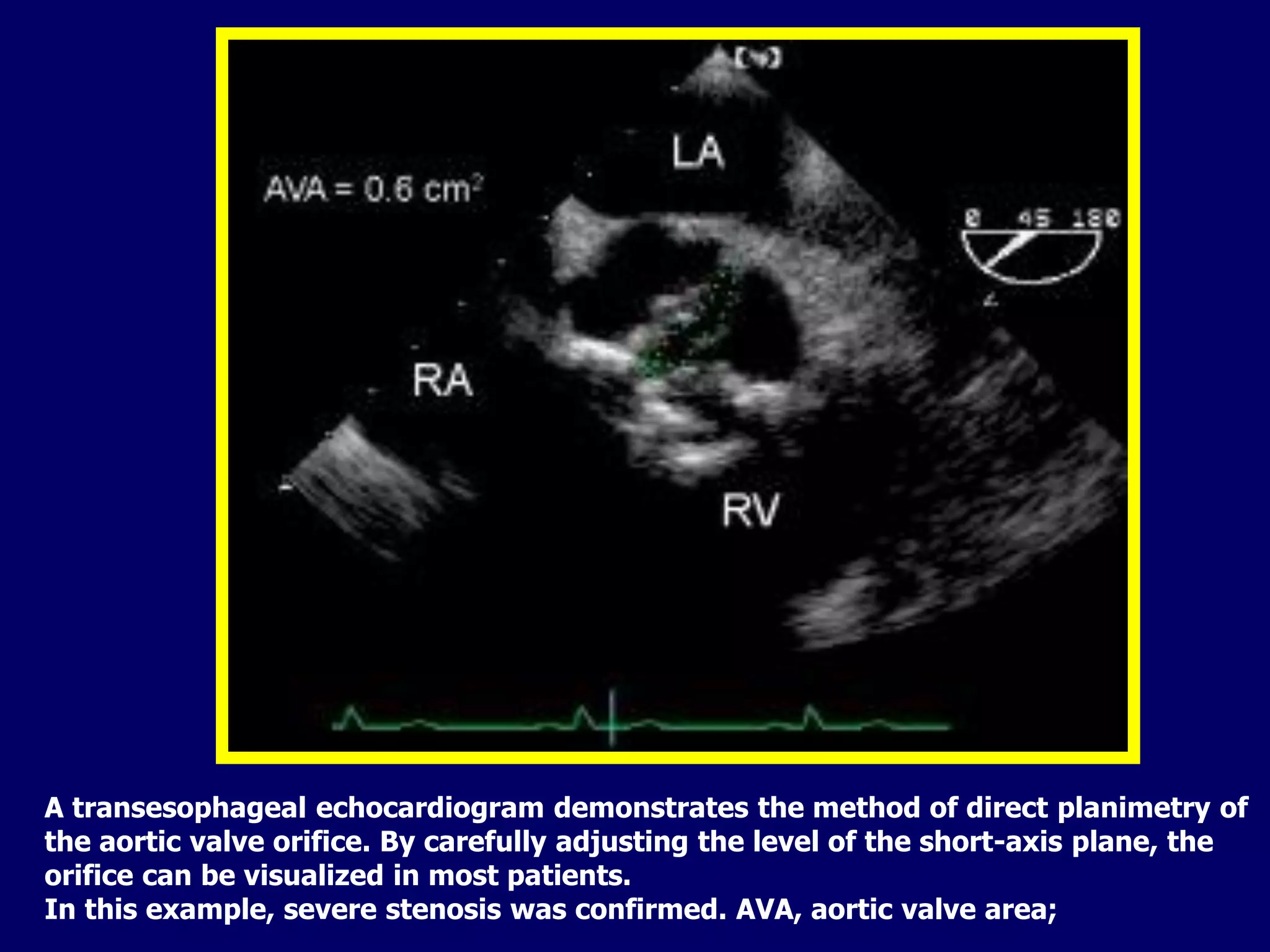 Lev Mendelevich MD — Trans Catheter Treatment of Structural Heart ...