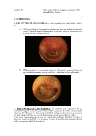 Otitis Media Crónica