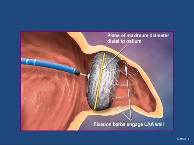 Dr. Raphael Rosso — The Watchman Left Atrial Appendage Occluder: Wher…