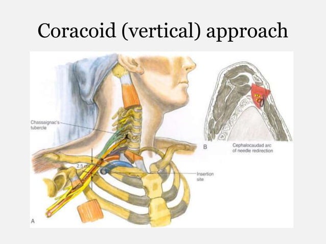 brachial plexus blocks | PPTX