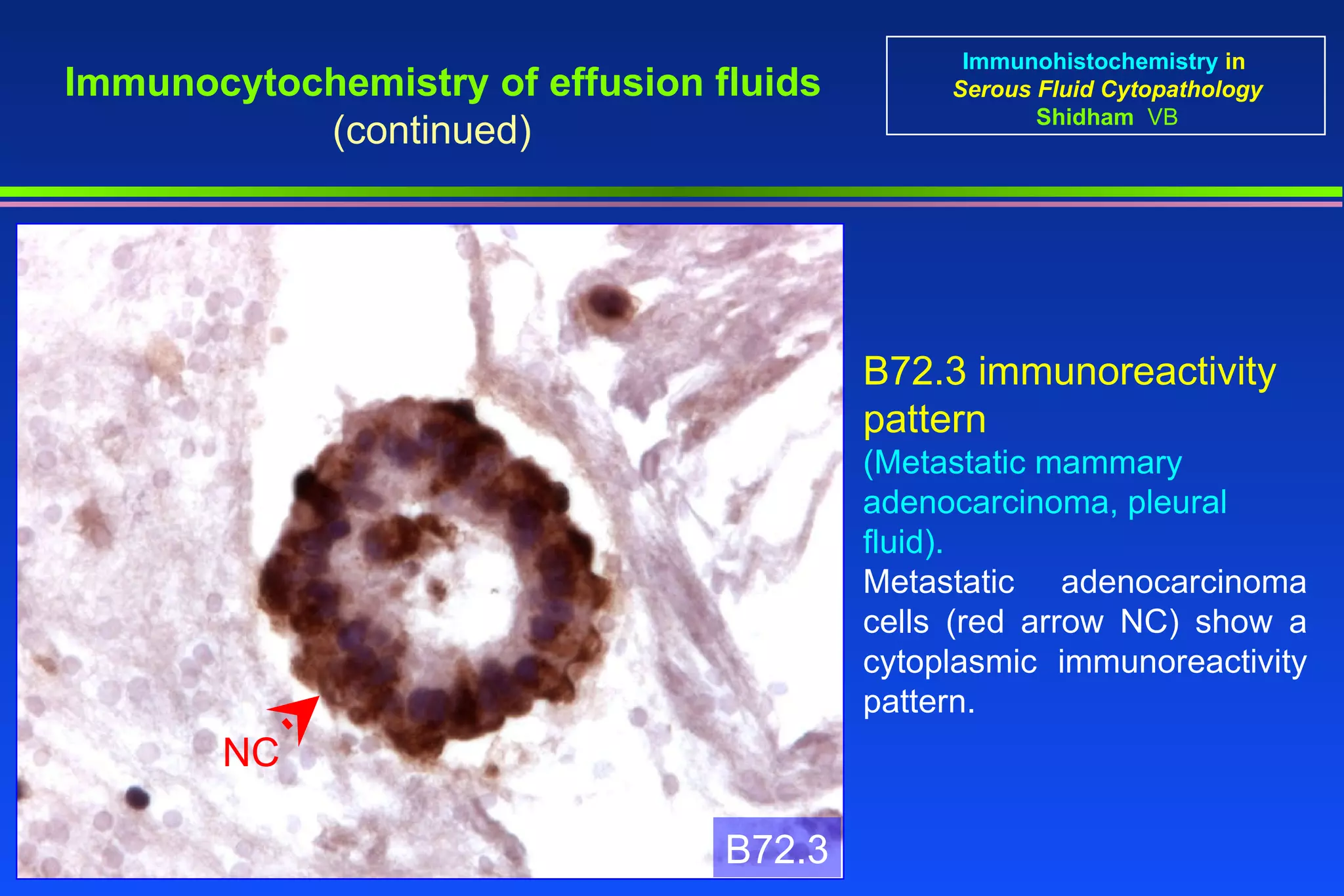 Shidham- Immunohistochemistry in Serous Fluid Cytopathology | PPT