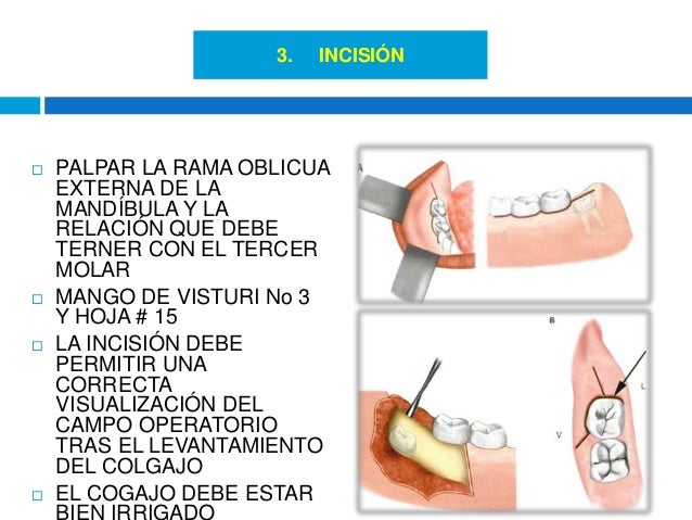 cirugia de terceros molares