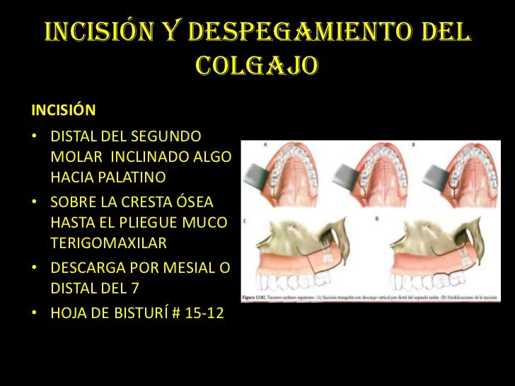cirugia de terceros molares