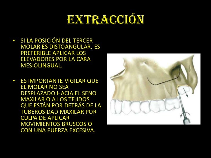 cirugia de terceros molares