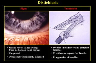 Distichiasis In Humans