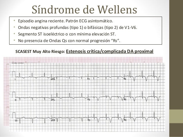 Relevancia del ECG en paucisintomáticos