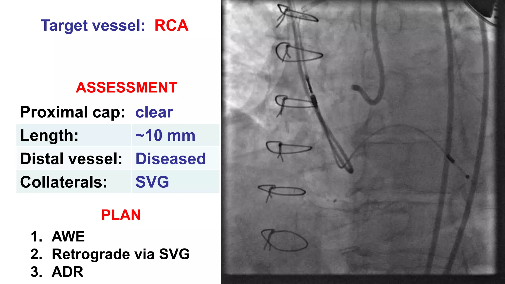 CTO in post CABG patients | PPTX