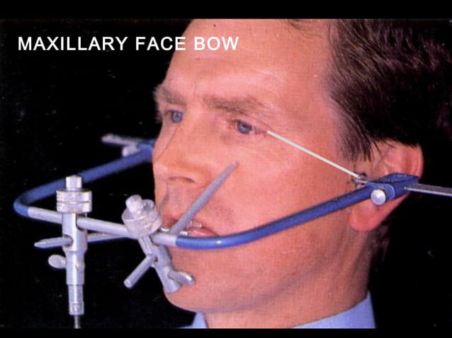 01 facebows and Articulators | PPT