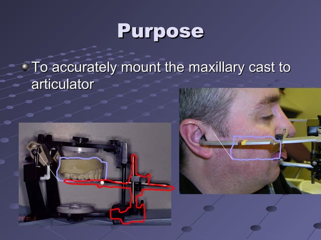 01 facebows and Articulators | PPT