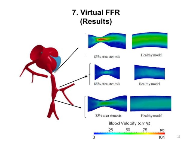 01 FFR Mongrain aimradial2017 - coronary blood flow | PPTX | Heart and ...