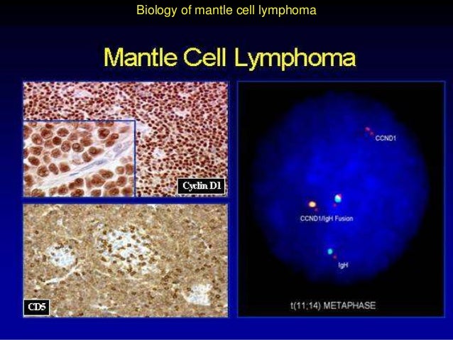 Mantle Cell Lymphoma From Bench To Clinic
