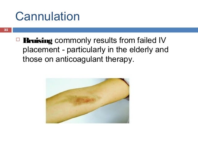 Intravenous cannulation