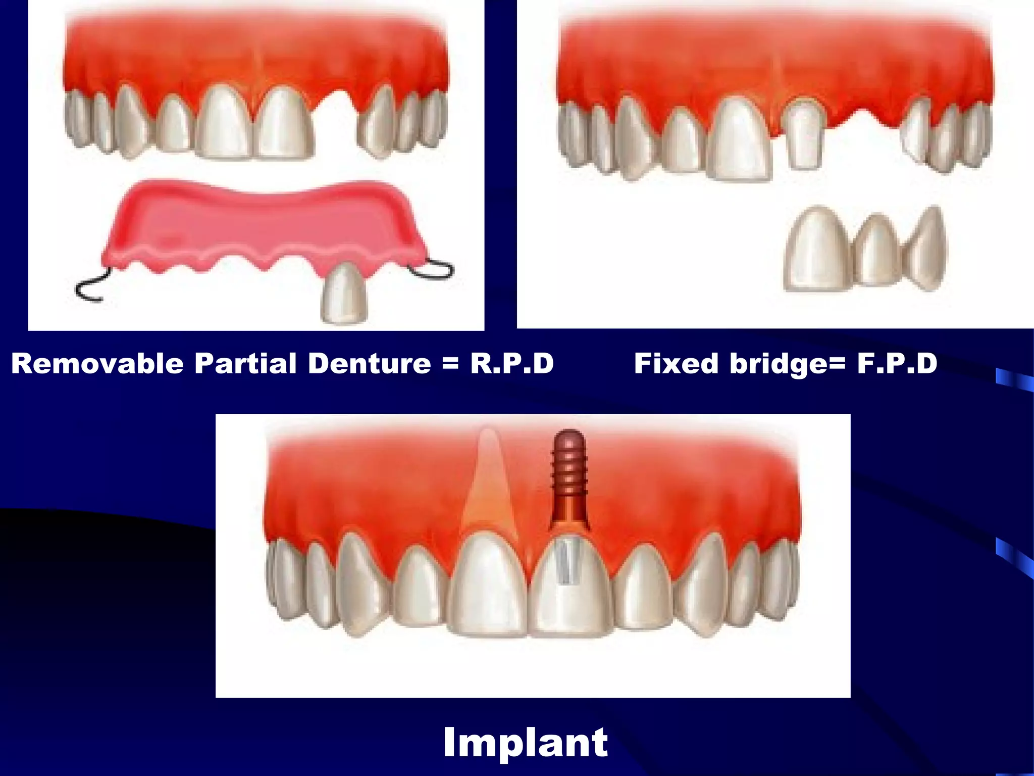01 introduction and objectives of rpd | PPT | Dental Health | Diseases ...