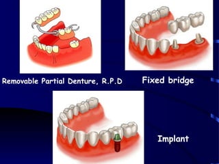 01 introduction and objectives of rpd | PPT | Dental Health | Diseases ...