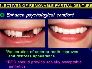 01 introduction and objectives of rpd | PPT | Dental Health | Diseases ...