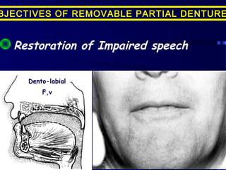 01 introduction and objectives of rpd | PPT | Dental Health | Diseases ...