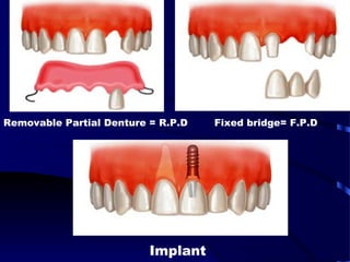 01 introduction and objectives of rpd | PPT | Dental Health | Diseases ...