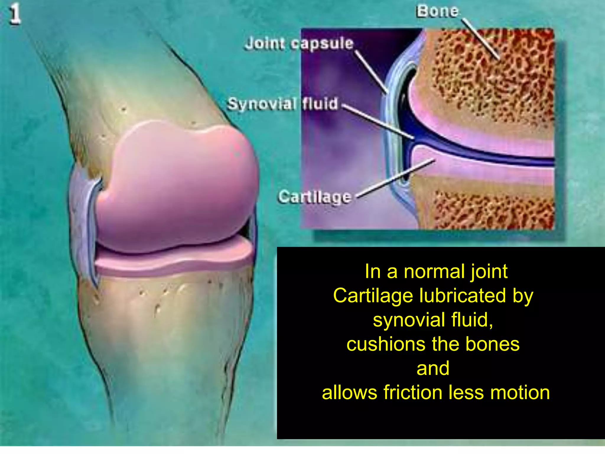 joint disorders part 1 | PPT