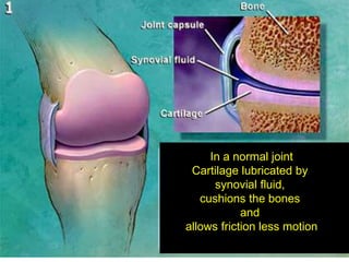 joint disorders part 1 | PPT